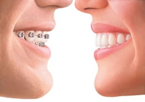 Invisalign Austin, Invisalign Express Starting at $2800