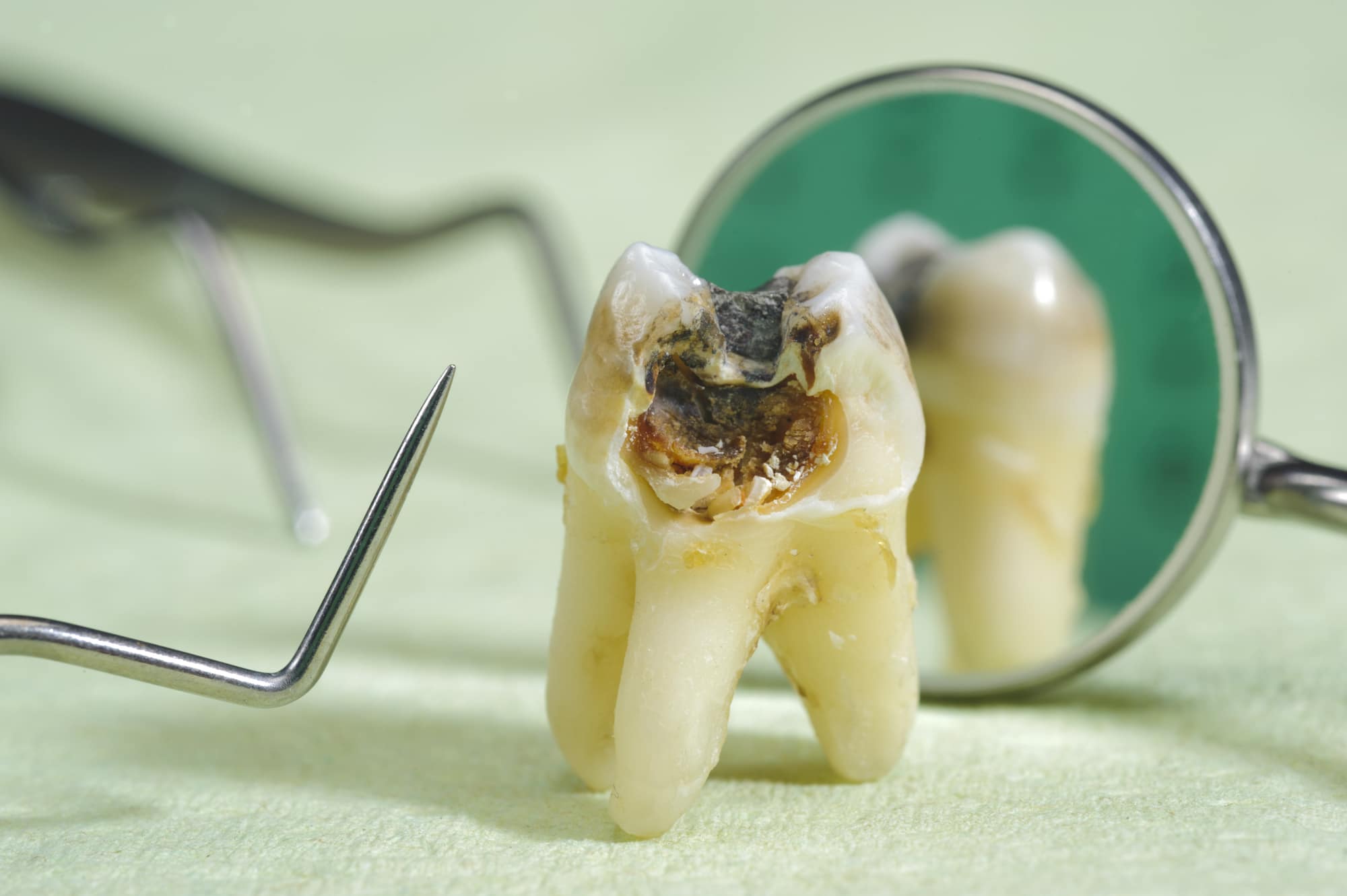 Three Unexpected Reasons Why You Have Cavities - Austin Laser Dentist